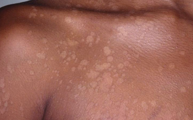 Infeksi Jamur Bisa Serang Siapa Saja, Cari Tahu Gejala dan Solusinya ...